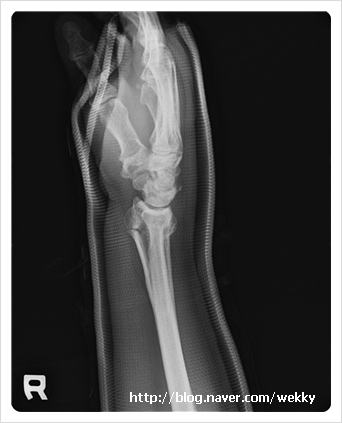 Fx. distal radius(intraarticular) & ulnar styloid process : 네이버 블로그