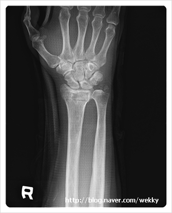 Fx. distal radius(intraarticular) & ulnar styloid process : 네이버 블로그