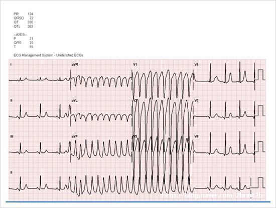 급발성 심실성 빈맥(Paroxysmal Ventricular Tachycardia) ?? : 네이버 블로그
