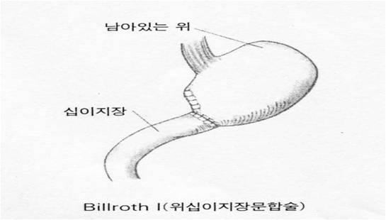 위부분절제 수술방법 (Billroth 1,2) : 네이버 블로그