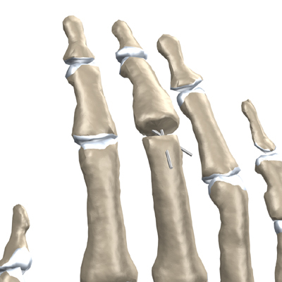 Volar plate injury (Swan neck deformity, 백조목 기형) : 네이버 블로그